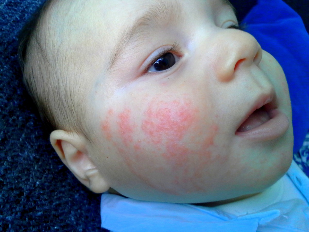 Cuidados diários… de uma pele atópica! - A Pitada do Pai